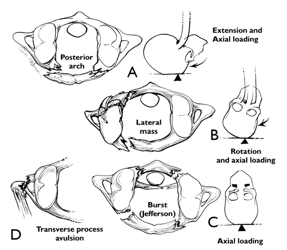 Jefferson Fracture Classification C1 Vertebral (Jefferson) Fractures